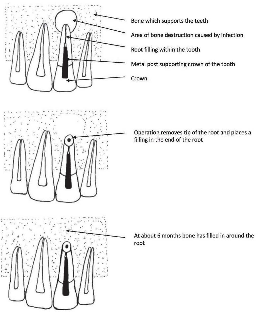 Apicectomy - University Hospitals Sussex NHS Foundation Trust