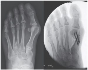 Minimally invasive Hallux Valgus (bunion) correction - University ...