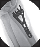 Distal Radius Fractures virtual hand fracture clinic - University ...