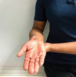 Distal Radius Fractures virtual hand fracture clinic - University ...