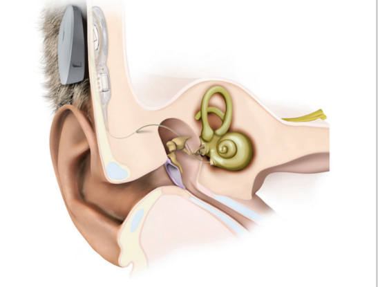 Hearing implant users information booklet - University Hospitals Sussex ...