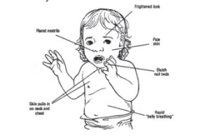 Viral Induced Wheeze: The Alex - University Hospitals Sussex NHS ...
