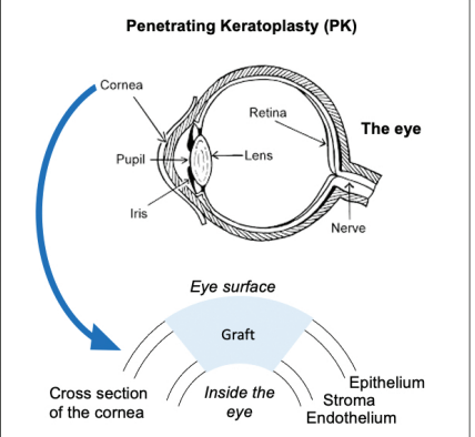 Full thickness corneal graft surgery - University Hospitals Sussex NHS ...