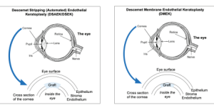 Endothelial Corneal Graft Surgery - University Hospitals Sussex NHS ...