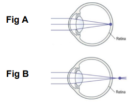 Hypermetropia (Long-sight) - University Hospitals Sussex NHS Foundation ...