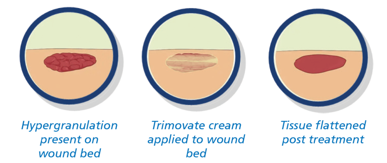 Treatment of Hypergranulation using Trimovate Cream - University ...