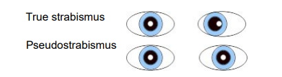 Pseudostrabismus - University Hospitals Sussex NHS Foundation Trust