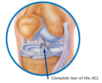 Advice following anterior cruciate ligament (ACL) reconstruction ...