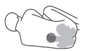 Lumbar puncture: The Alex - University Hospitals Sussex NHS Foundation ...