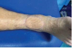 Open fractures - University Hospitals Sussex NHS Foundation Trust