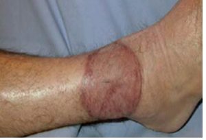 Open fractures - University Hospitals Sussex NHS Foundation Trust