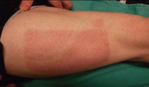 Open fractures - University Hospitals Sussex NHS Foundation Trust