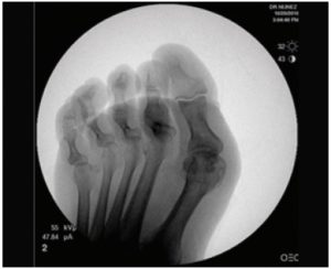 Corrective Surgery of Lesser Toes - University Hospitals Sussex NHS ...