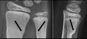 Buckle fracture: The Alex - University Hospitals Sussex NHS Foundation ...