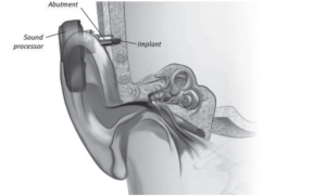 Hearing implant users information booklet - University Hospitals Sussex ...