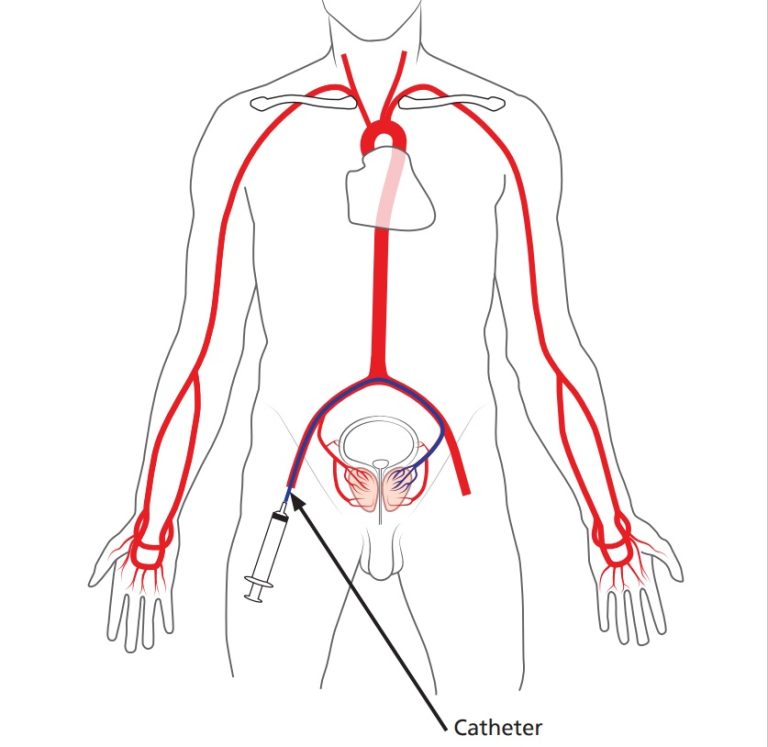 Prostate Artery Embolisation - University Hospitals Sussex NHS ...