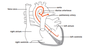 Patent Ductus Arteriosus (PDA) - University Hospitals Sussex NHS ...