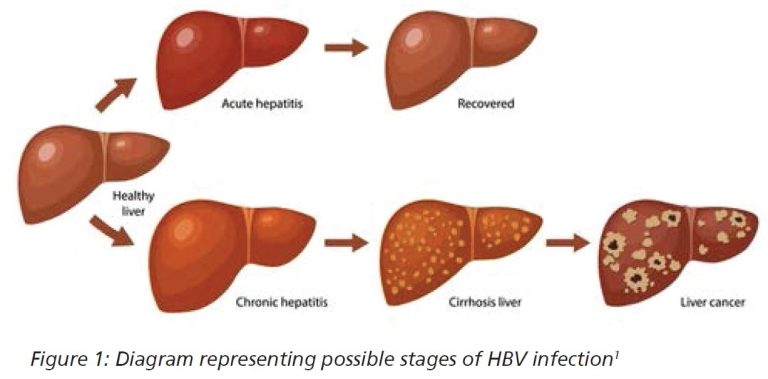 Chronic Hepatitis B virus (HBV) - University Hospitals Sussex NHS ...