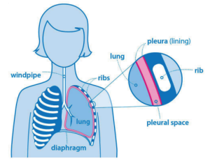 Chest drains - University Hospitals Sussex NHS Foundation Trust
