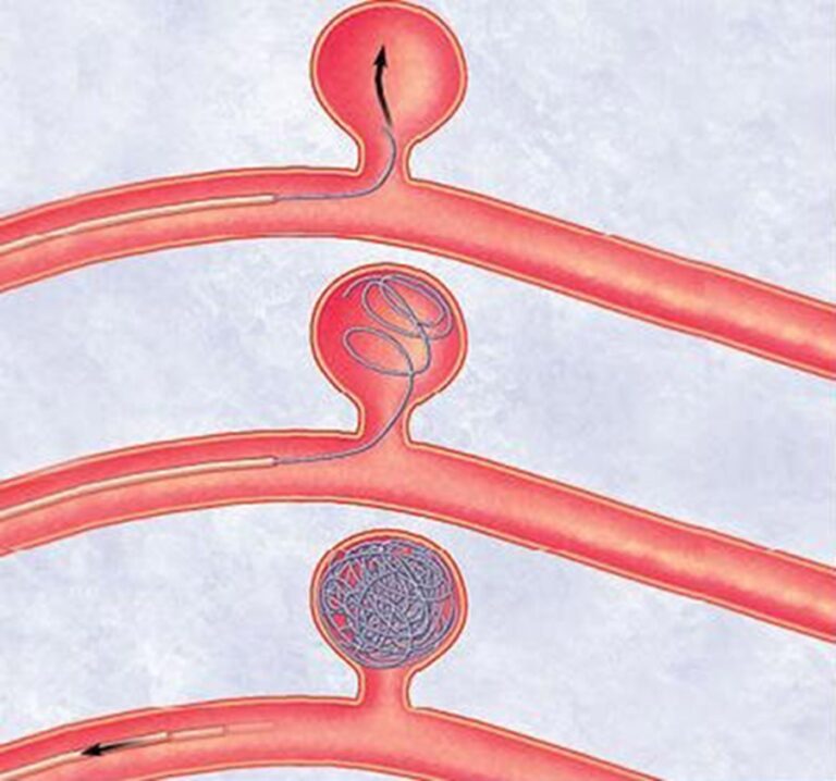 Brain aneurysm - University Hospitals Sussex NHS Foundation Trust