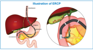 About Your ERCP Examination - University Hospitals Sussex NHS ...