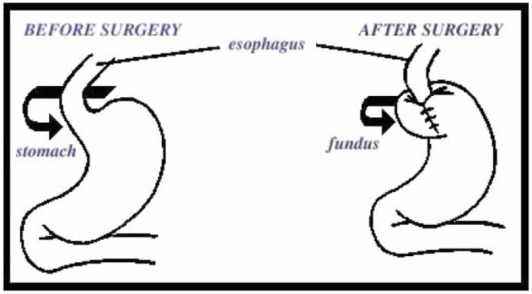 Dietary advice for patients following anti-reflux surgery - University ...