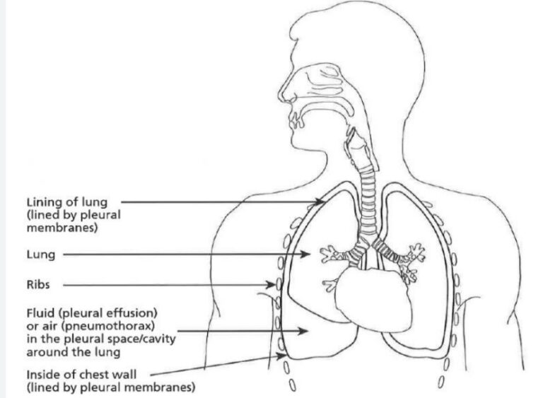 Indwelling Pleural Catheter (IPC) - University Hospitals Sussex NHS ...