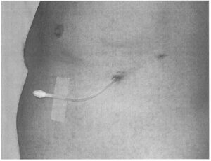 Indwelling Pleural Catheter (IPC) - University Hospitals Sussex NHS ...