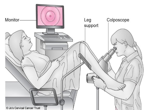 Having a colposcopy - University Hospitals Sussex NHS Foundation Trust