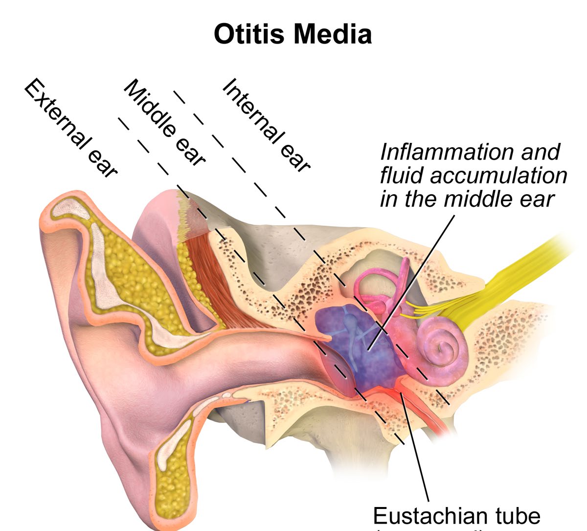 Otitis Media - The Alex - University Hospitals Sussex NHS Foundation Trust