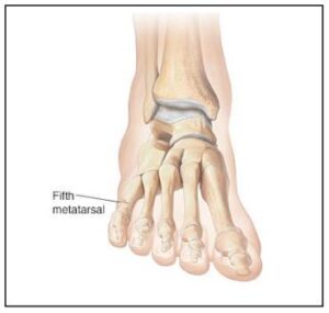 Base of 5th Metatarsal Fracture - University Hospitals Sussex NHS Foundation Trust
