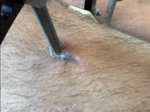 How to care for your pin site - University Hospitals Sussex NHS ...