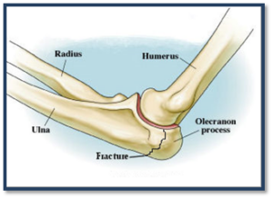 Olecranon elbow fracture - University Hospitals Sussex NHS Foundation Trust